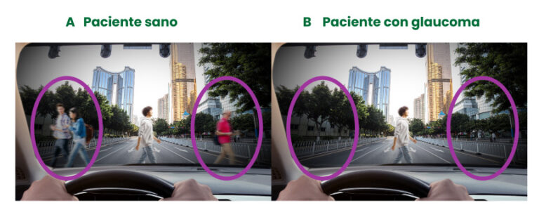 ¿Cómo ve una persona con glaucoma? – Laboratorios Grin